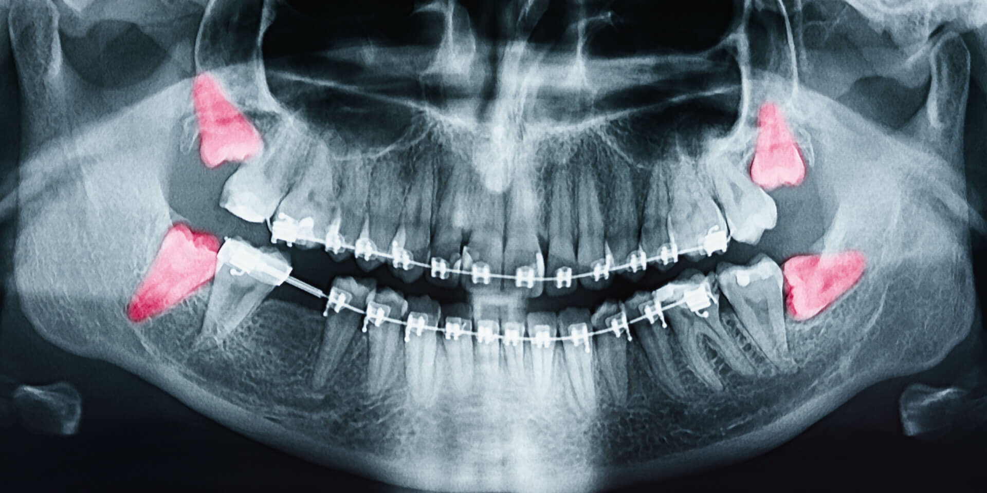 The Best Place For Wisdom Teeth Removal Procedures